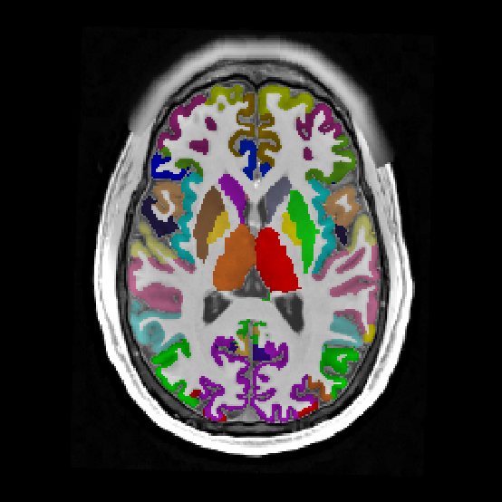 MarsAtlas + subcortical » MeCA research group